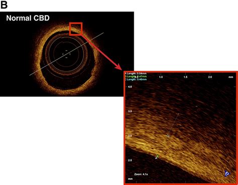 An Intrapancreatic Cholangiocarcinoma Detected With Optical Coherence Tomography During