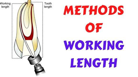 Endodontic Lecture Root Canal Procedure Method Of Working Length Determination Rct Part 2