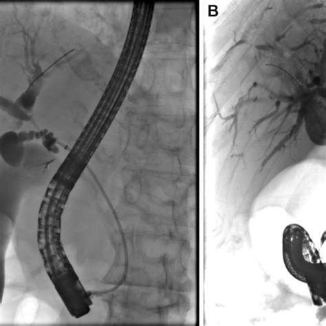 Spyglass Cholangioscopy Demonstrating Infiltrative Mass In The Bile Download Scientific Diagram