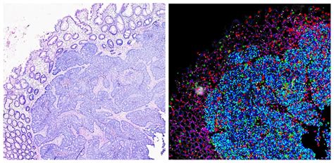 Investigating Tumor Dissemination By Spatial Transcriptomics 奥林巴斯生物显微镜
