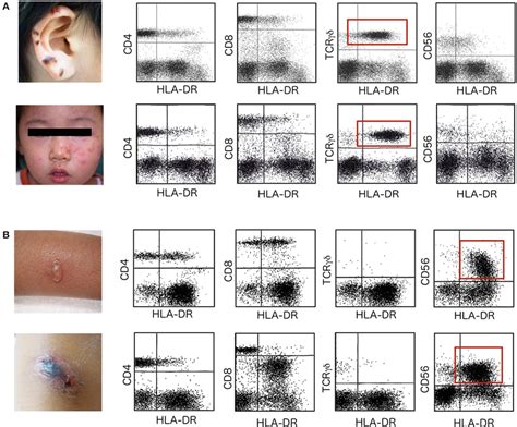 Hla Dr Expression On Lymphocyte Subpopulations Flowcytometric Analysis Download Scientific