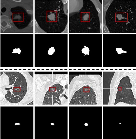 Figure 1 From Lung Nodule Segmentation Algorithm With Smr Unet Semantic Scholar