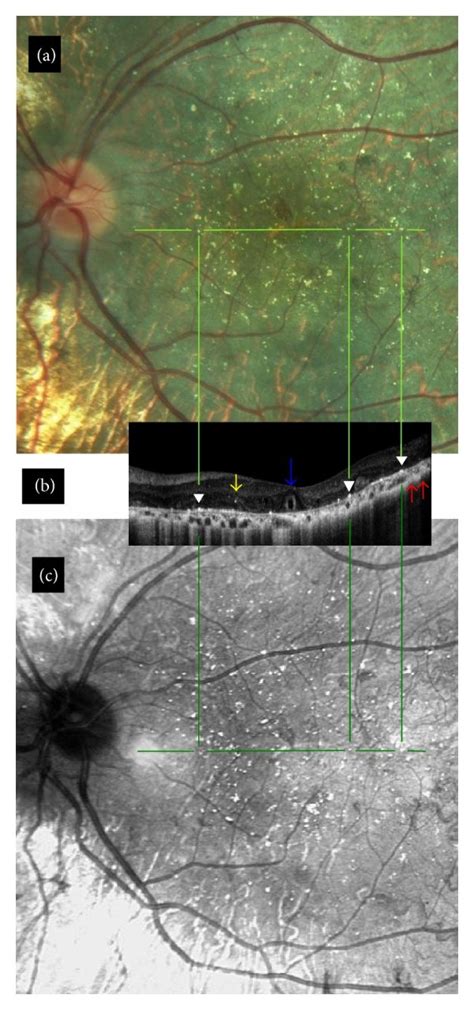 Case 1 Left Eye Transverse Oct Section Showing The Associated