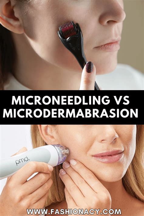 Microneedling Vs Microdermabrasion Which Is Better