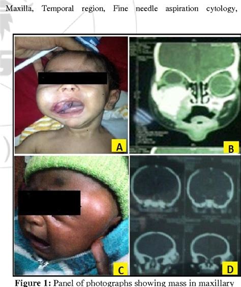 Figure 1 From Melanotic Neuroectodermal Tumor Of Infancy A Rare Pediatric Tumor Report Of Two