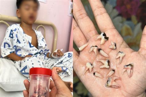 12 Batang Gigi Terpaksa Dicabut Akibat Jarang Gosok Tidur Hisap Botol
