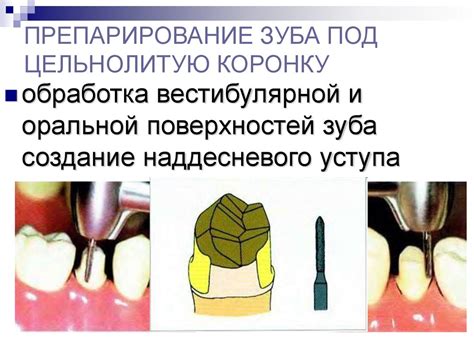Особенности препарирования зубов под металлические коронки. Лекция №3 ...