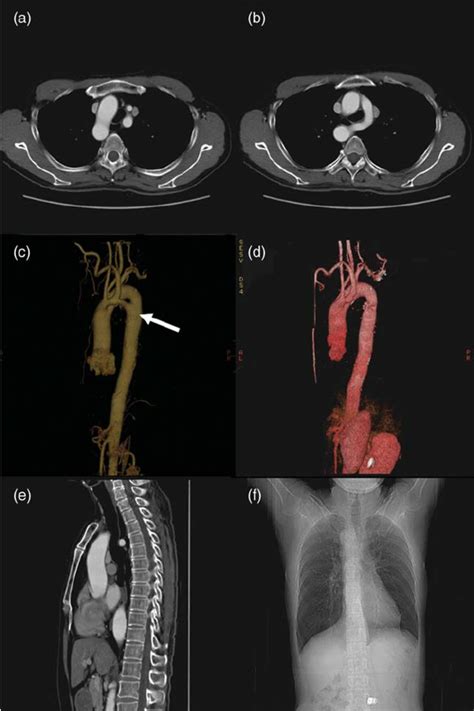 Contrast Enhanced Ct Showing A Daa Involving A Complete Vascular Ring