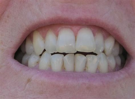 Does Regenerate Toothpaste Really Work To Rebuild Enamel And Repair Tooth Enamel Erosion Hubpages