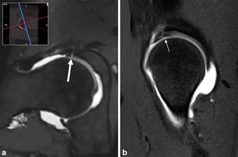 Mri Hip Arthrogram With Radial Mpr Slice Thickness 1 Mm Of An Download Scientific Diagram
