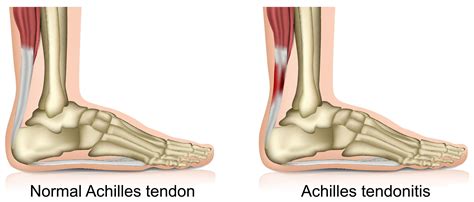 Bike Radar What Causes Achilles Pain
