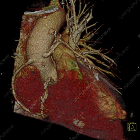 Heart Ct Scan Stock Image C058 4533 Science Photo Library