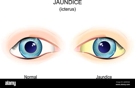 Eyes During Jaundice At Sally Seim Blog