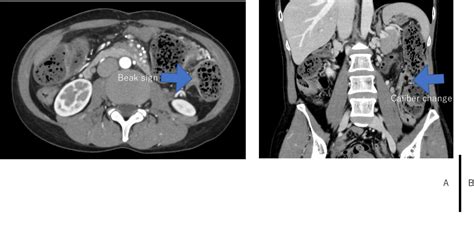 Figure 1 From The First Case Of Splenic Flexure Volvulus Treated With Reduced Port Surgery Using