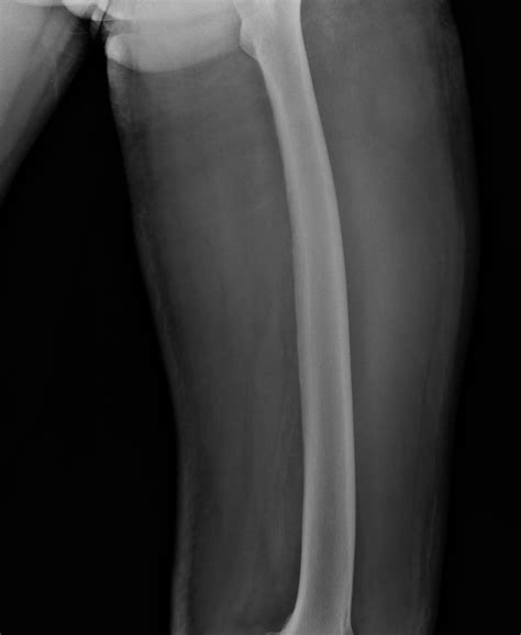 Hematoma Por Golpe Cómo Tratarlo Y Cuándo Preocuparse Efisio
