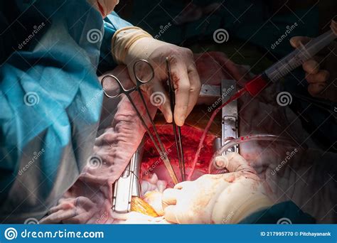 Coronary Artery Bypass Graft Operation Cabg Stock Photo Image Of