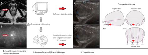 Software Based And Cognitive Mpmri Targeted Biopsy Techniques In The Download Scientific