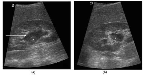 Pyonephrosis Ultrasound
