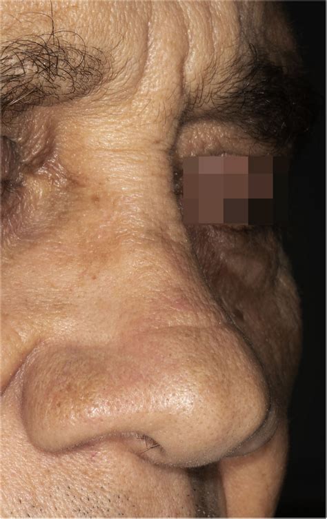 Successful Treatment Of Diffuse Cutaneous Leishmaniasis Caused By Leishmania Amazonensis Anais