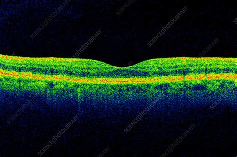 Normal Retina Oct Scan Stock Image C026 7621 Science Photo Library
