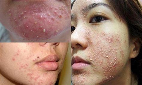 M Ph M G Y K Ch Ng V D Ng Da Nh Th N O