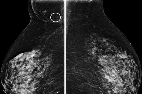 The Abcs Of Accessory Breast Tissue Basic Information Every