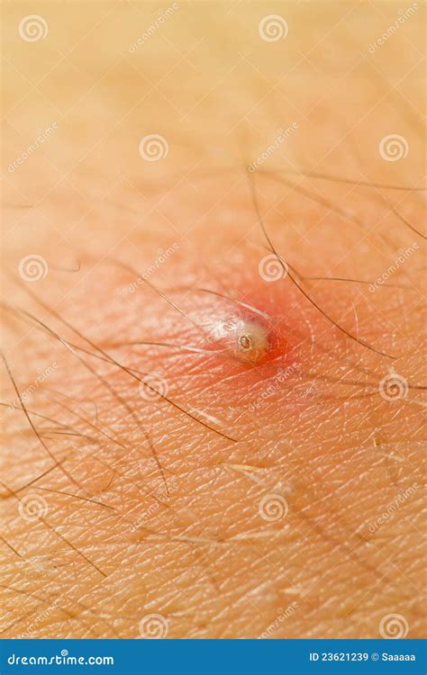 Pimple Extreme On Human Skin Royalty Free Stock Photography CartoonDealer Com 25995239