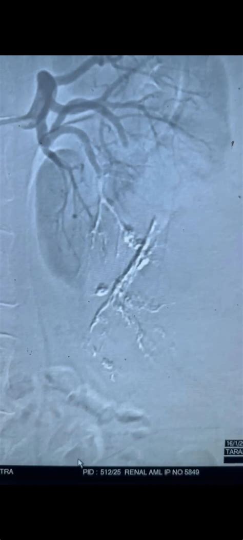 Case Of Ruptured Renal Aml With Psa Angio Embolization Done With 20