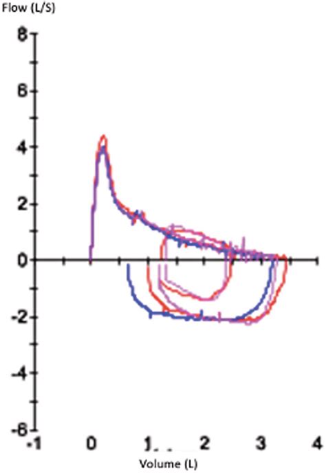 Flow Volume Loop Of The Pulmonary Function Tests June 2013 Download