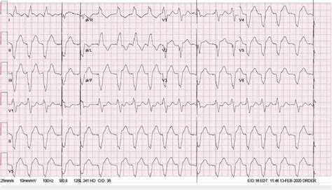 Electrocardiogram On Initial Presentation Showing Crt Pacing