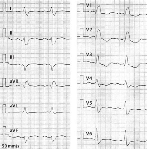 Mixed Types Of Block Thoracic Key