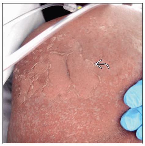 Acute Generalized Exanthematous Pustulosis Basicmedical Key