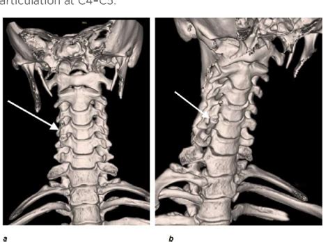 Accessory Articulation Of Cervical Vertebral Transverse Process A Rare
