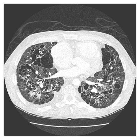 Metastatic Angiosarcoma Of The Scalp Presenting With Cystic Lung