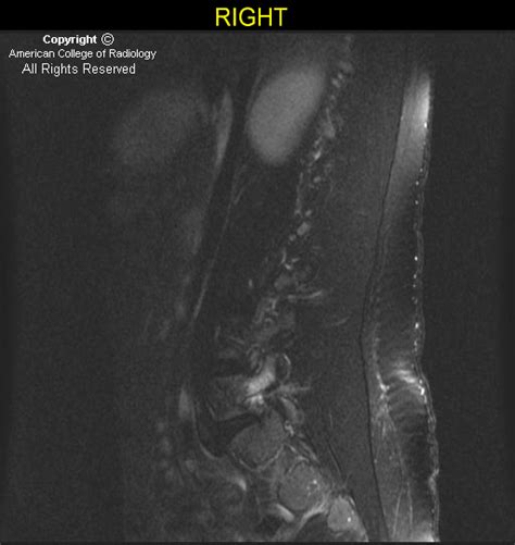 Neuroradiology On The Net Pars Interarticularis Stress Fracture