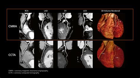 Cardiovascular Mri Siemens Healthineers