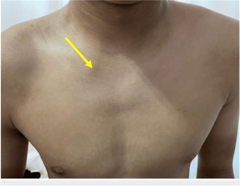 Pdf Posterior Dislocation Of The Sternoclavicular Joint In A Patient