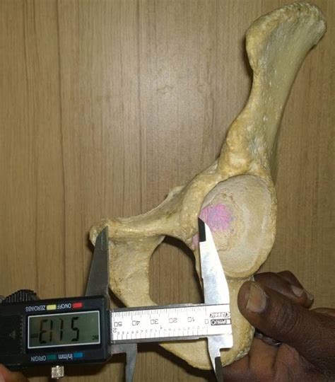 Sex Determination By Biometry Of Anterior Features Of Human Hip Bones