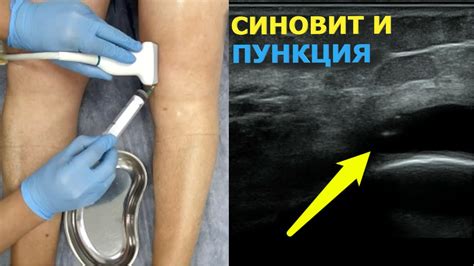 Пункция коленного сустава с УЗИ Youtube