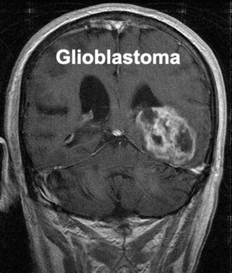 Glioblastome Grade 4 Oms Glioblastome Stade 4 Définition Wyac