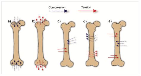 Schematic Representation Of A A Vertebral Augmentation Procedure And