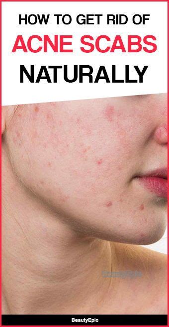 How To Get Rid Of Pimple Scabs