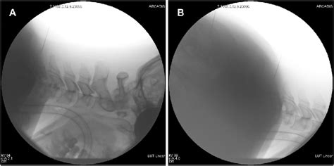 The Visualization Of Lateral View In Intraoperative Needle Download Scientific Diagram
