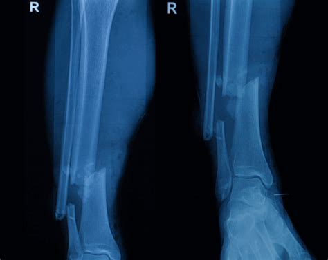 Right Tib Fib X Ray Ah Desert Mobile Medical Concierge