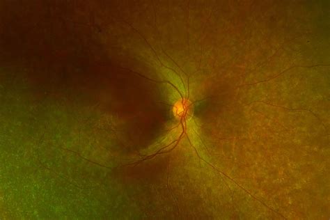 Ophthalmic Gene Therapy Subretinal Injection Learn And Share Leica