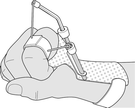 Guide Mcp Arthroplasty Splint