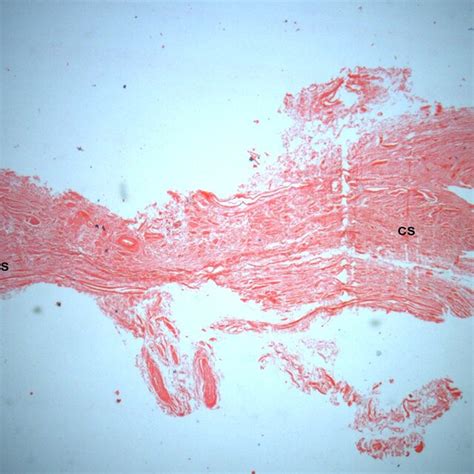 Pdf Pseudodiphallia With Duplication Of Urethra Pseudodifalia Con