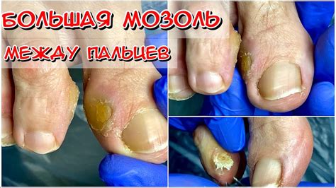 Большая мозоль между пальцев Целующиеся мозоли мозоль от обуви Youtube