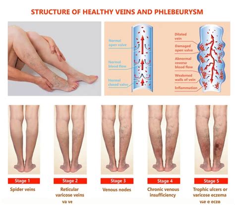 Thrombophlebitis Deep Vein Thrombosis Varicose Veins Phlebeurysm