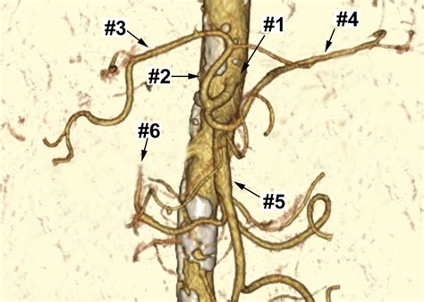 Ct Angiographic Reconstruction Using Volume Rendering Reconstructed 3d Download Scientific